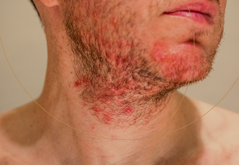 Foliculite - Dra. Ladia